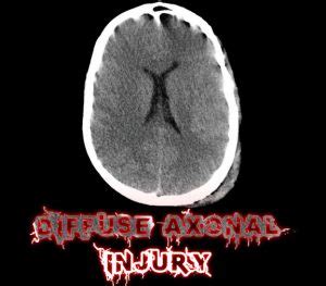Diffuse Axonal Injury Ketahui Sebab Gejala Dan Cara Sembuh