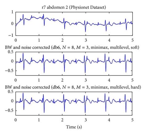 R7 Abdomen 2 Abdominal And Direct Fetal Electrocardiogram Database Download Scientific Diagram
