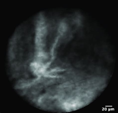 Papillary Projections Characterized By A Vascular Core White Download Scientific Diagram