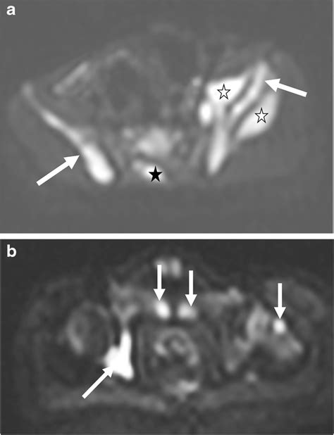High B Value Diffusion Weighted Mr For Detecting Multifocal Burkitt Download Scientific Diagram