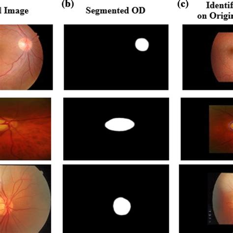 Two Stage Framework For Optic Disc Segmentation And Estimation Of Cup To Disc Ratio Using Deep