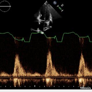 The Mitral Valve Inflow Pattern Showed A Fusion Of E And A Waves Download Scientific Diagram