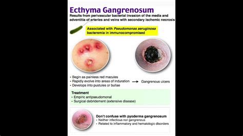 Ecthyma Gangrenosum
