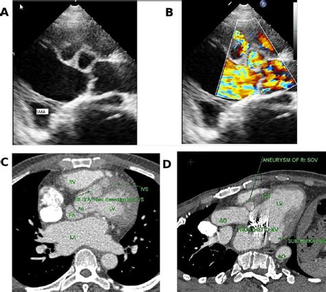 Echo And Cardiac Ct Angio Images Panel A Is A 2 D Echo Image Showing