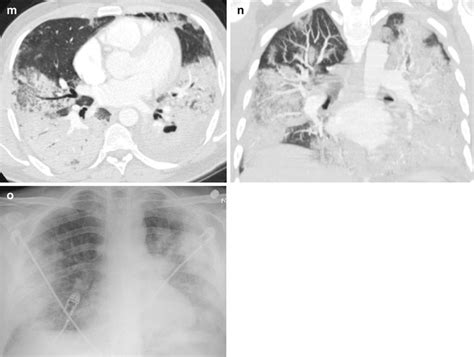 Vasculitis Radiology Key
