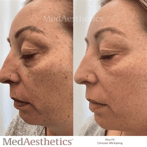 Pico Genesis FX Perth Medaesthetics Cosmetic Skin Clinic