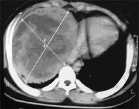Computed Tomography Thorax Showing Inhomogeneously Enhancing Mass