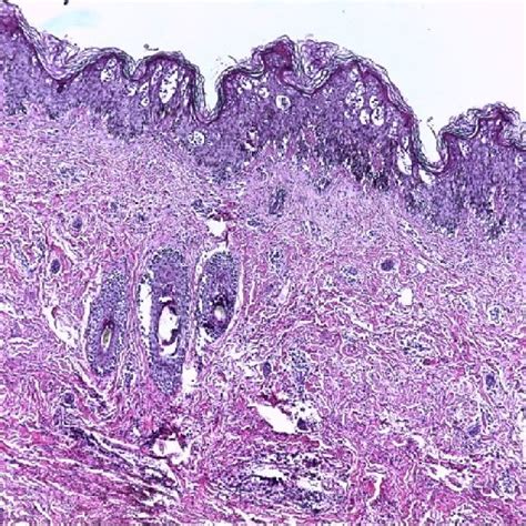 Pyoderma Gangrenosum Large Purulent Ulcer With Violaceous Undermined Download Scientific