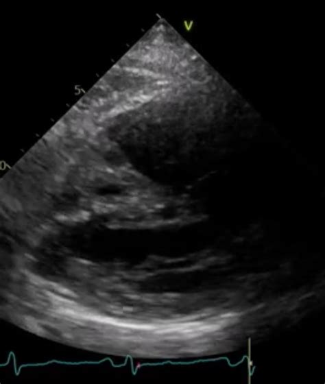 Right Ventricular Systolic Function Part 1 Of 3 Openanesthesia