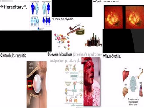 Optic Nerve Optic Atrophy Clinical Round Ppt