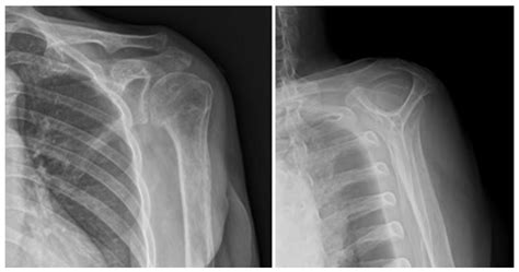 Left Shoulder X Ray Showed Diffuse Osteopenia Osteophyte At Humeral Download Scientific