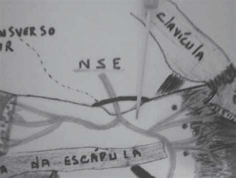 Site Of Introduction Of Anesthetic To Block Efficacy Download