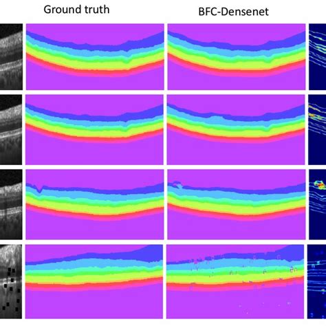 Examples Of Retinal Layer Segmentation And Uncertainty Quantification Download Scientific