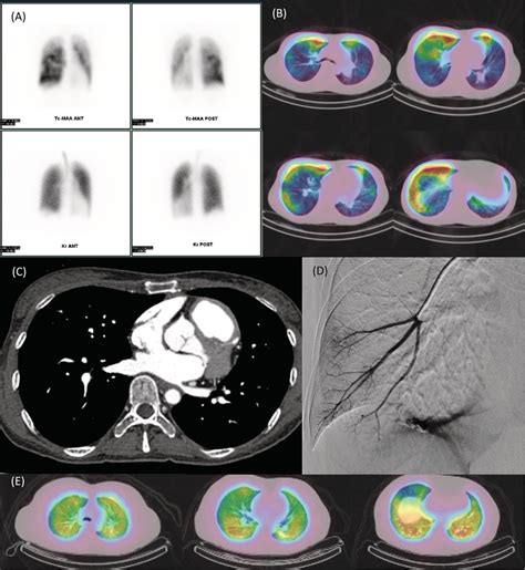 A Perfusion Lung Scan Which Is Performed With Technetium 99m Download Scientific Diagram