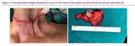 Parathyroid Carcinoma Presenting As Recurrent Primary Hyperparathyroidism And Neck Mass A Case
