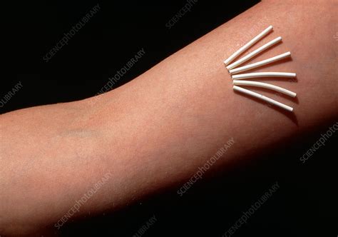 Norplant Contraceptive Implants Stock Image M8600101 Science