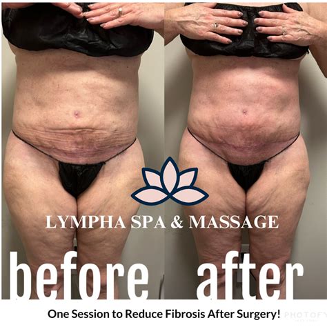 Post Surgery Lymphatic Massage Lympha Spa And Massage