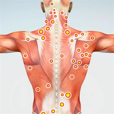 Trigger Point Doctor In Calgary Divergent Health