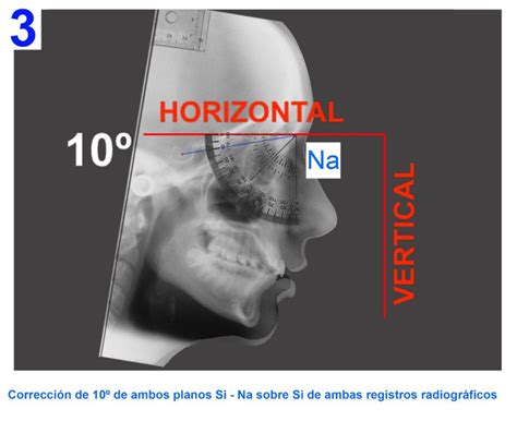 Evaluación De Los Cambios Faciales Y Dentoalveolares En Pacientes Tratados Con Twin Block