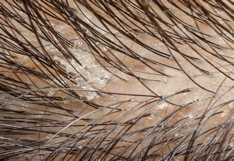 Flaky Scalp Itchy Scalp Condition Get Treatment For It Today Flaky Scalp Itchy Scalp Condition Get Treatment For It Today
