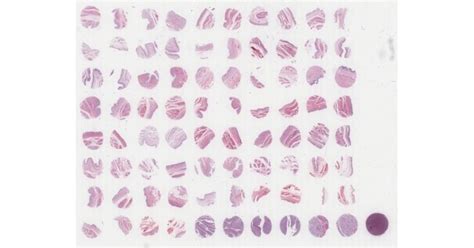 Bnc12011 Normal Bladder Tissue Array Including Tnm Clinical Stage And Pathology Grade 40