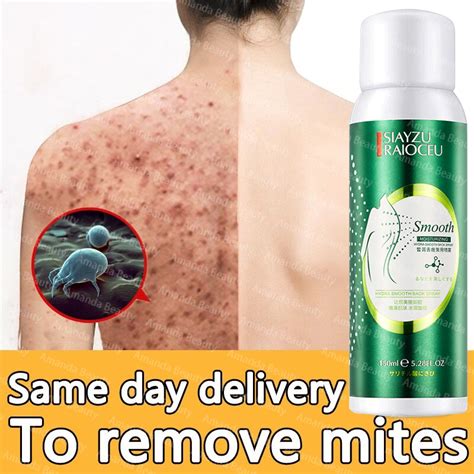 Back Acne Treatment Spray Antibacterial Anti Acne Gentle Exfoliating Back Mist[pimple Fighting