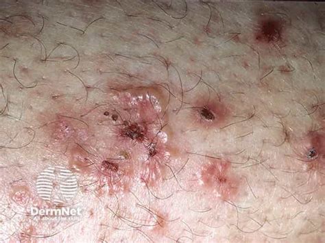 Dermatitis Herpetiformis Dermatitis Herpetiformis Primary Care