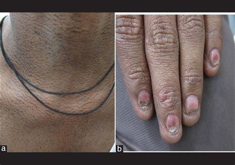 Reticular Pigmented Anomaly Of The Flexures