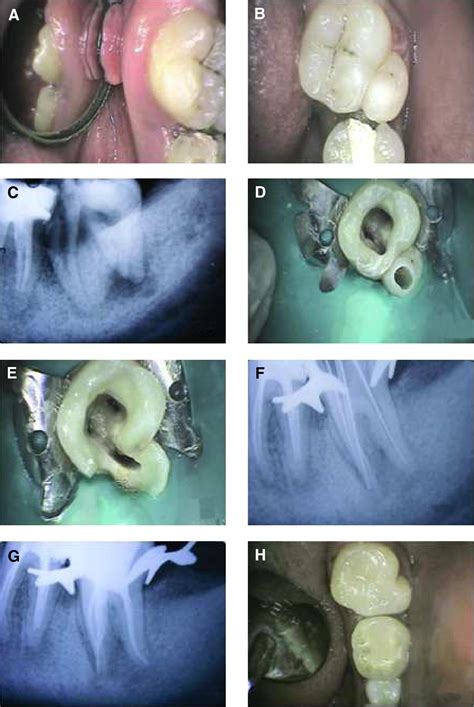 Endodontic Management Of A Fused Mandibular Second Molar And Paramolar