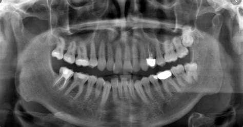 Normal Wisdom Teeth X Ray