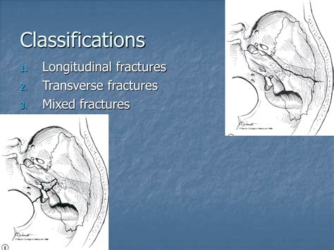 Ppt Fracture Of Temporal Bone Powerpoint Presentation Free Download