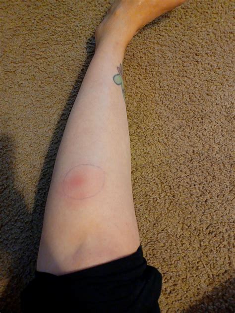 Dont Believe My Doctor That What I Have Is Cellulitis As I Have It On