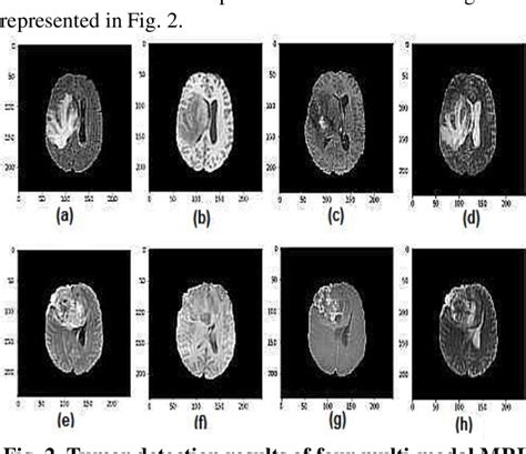 table 2 from an efficient cascaded cnn architecture for brain tumor