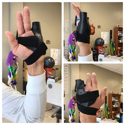 Ulnar Gutter Splint