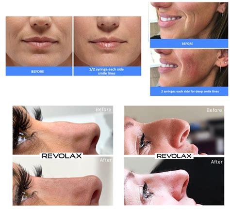 Revolax Deep Korean Fillers