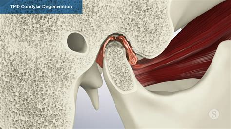 Tmj Anatomy Physiopedia