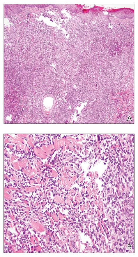 Agminated Nodules On The Scalp Mdedge