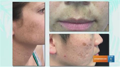 Identifying The Causes Of Melasma And Treatment Options Available