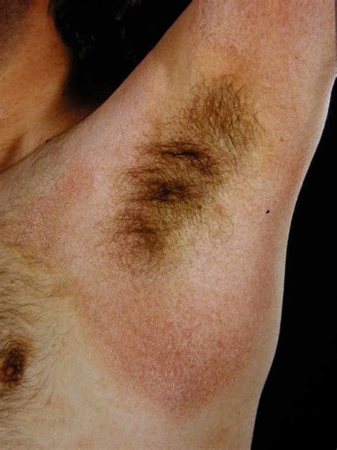 Underarm Rash Pictures How Irritated Armpits Look