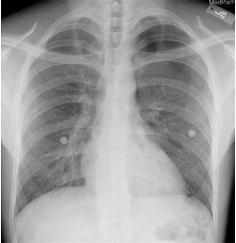 Chest Image Evaluation Diagram Quizlet