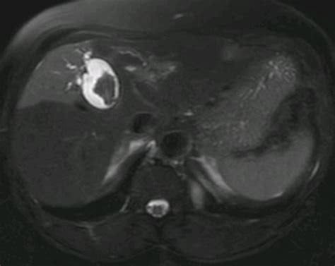 Liver Atlas Diagnosis Biloma