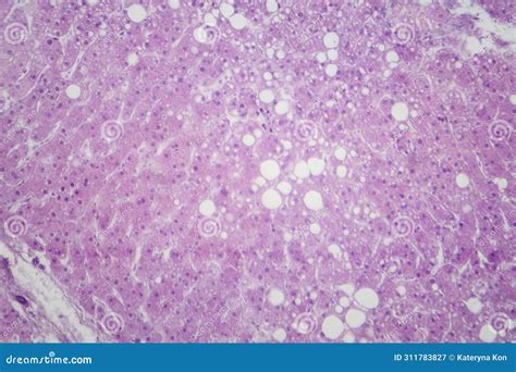 Hepatic Steatosis Light Micrograph Stock Image