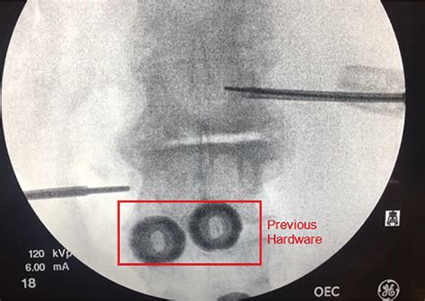 Anatomic Physiologic Indirect Decompression Anesthesia Key