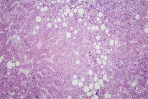 Hepatic Steatosis Light Micrograph Stock Photo Image Of Liver Alcohol 311783318