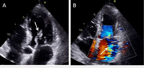 Comprehensive Transthoracic Echocardiogram Transthoracic Echocardiogram Download Scientific