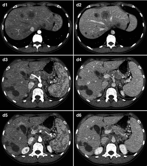 Hepatic Artery Embolizations Thoracic Key