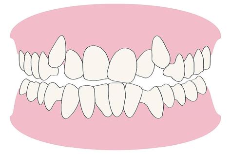 What Is Dental Crowding Dental Crowding Is A Condition That Occurs When There Is Insufficient