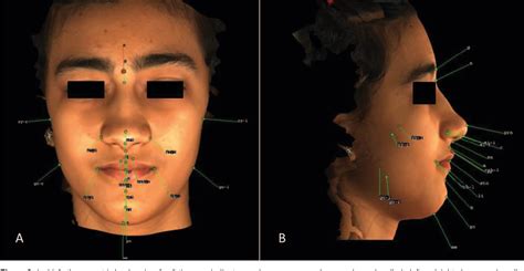Figure 1 From Three Dimensional Soft Tissue Evaluation After Rapid Maxillary Expansion And