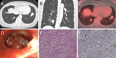bronchoscopic diagnosis of hematogenous recurrence of thymoma