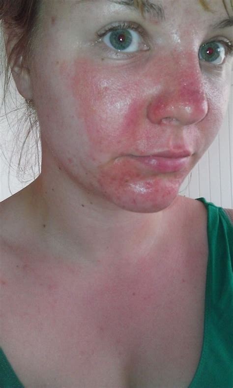 Cellulitis Cheek
